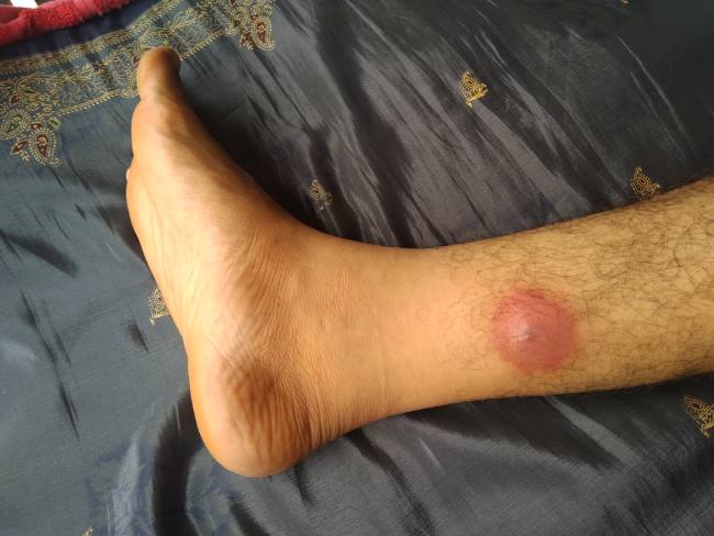 Bisul di Kaki, Penyebab dan Cara Mengobatinya yang tepat - Alodokter