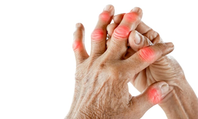 10 Obat Encok yang Ampuh - Alodokter