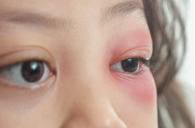 Mata Tiba-Tiba Bengkak, Ketahui Penyebab dan Cara Mengatasinya - Alodokter