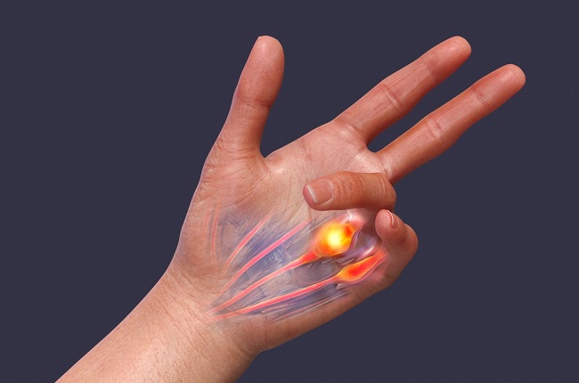 Kontraktur Dupuytren: Terapi Injeksi vs Bedah – Telaah Jurnal Alomedika ...