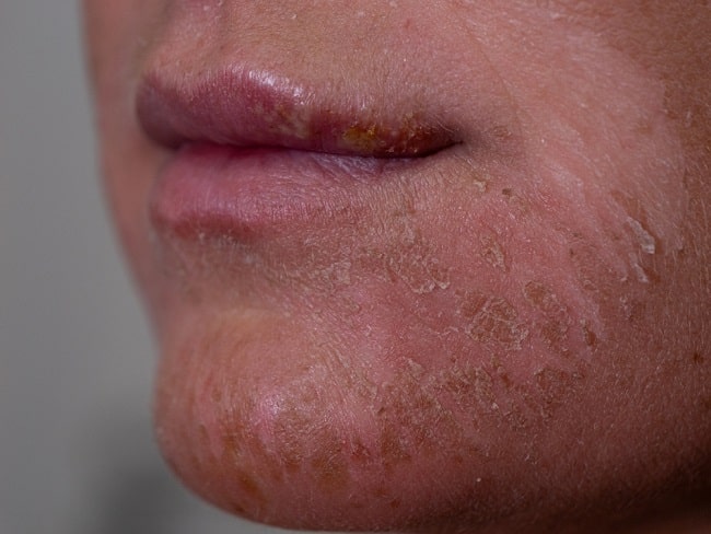 Bahaya Penggunaan Phenol Untuk Deep Peeling Parut Bekas Jerawat - Alomedika