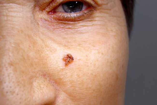 Kutil di Wajah, Kenali Penyebab dan Cara Mengatasinya - Alodokter