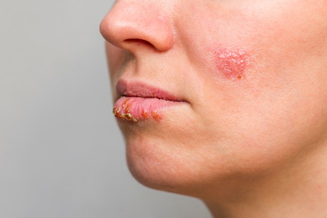 Herpes di Wajah, Ketahui Penyebab dan Cara Mengatasinya - Alodokter