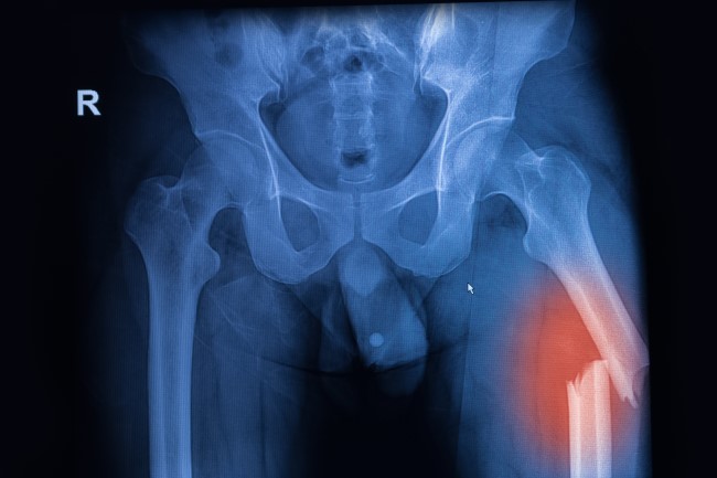 Patah Tulang Paha – Gejala, Penyebab, dan Pengobatan – Alodokter