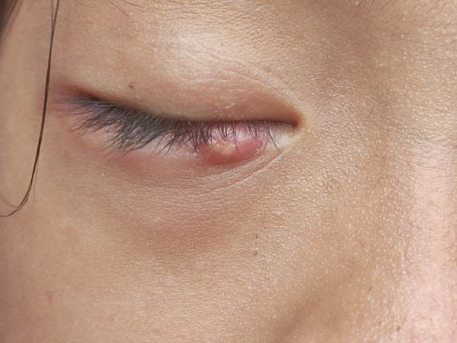 Bisul di Mata, Ketahui Penyebab dan Cara Mengatasinya - Alodokter