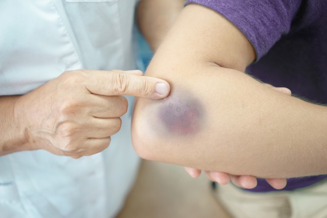 Ekimosis, Kenali Penyebab dan Cara Mengatasinya dengan Tepat - Alodokter