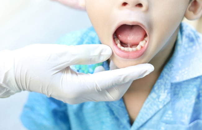 Perbedaan Lidah Normal dan Tongue Tie yang Perlu Orang Tua Ketahui ...