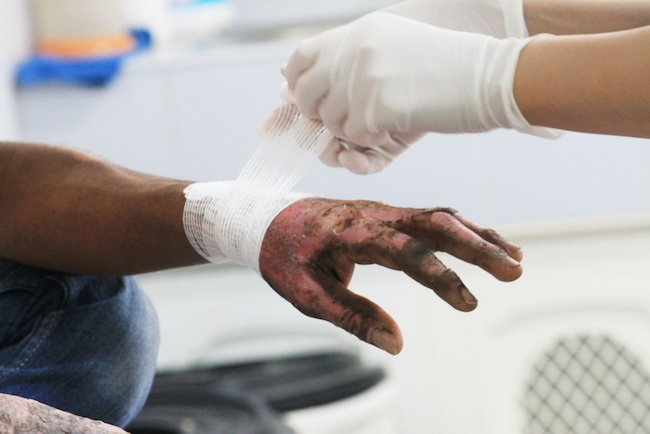 Antibiotik Oral untuk Mencegah Infeksi pada Luka Bakar - Alomedika
