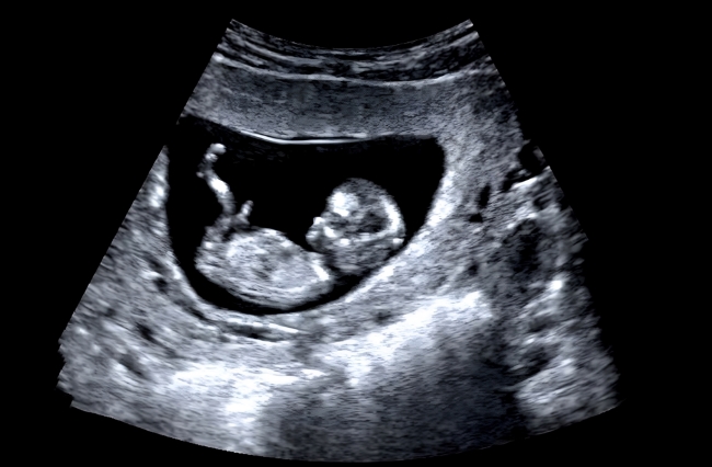 Berat Normal Janin 36 Minggu dan Tips Menjaganya - Alodokter