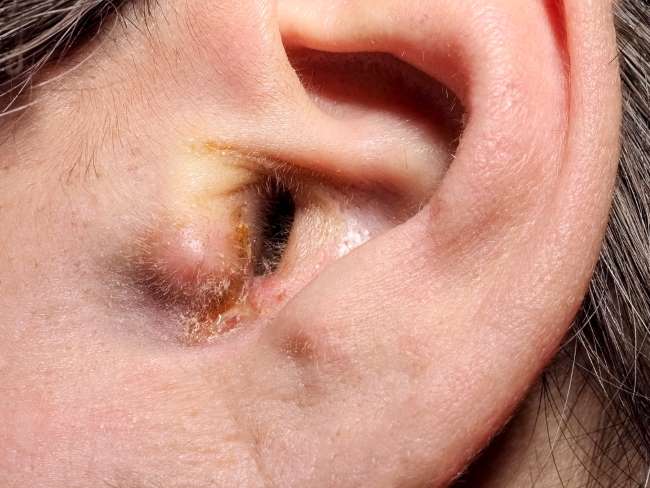 Jamur Telinga, Kenali Gejala, Penyebab, dan Cara Mengatasinya - Alodokter