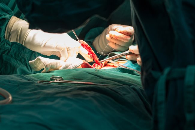 Operasi Usus Buntu Berapa Lama? Ketahui Estimasi Waktunya Sampai Pulih - Alodokter