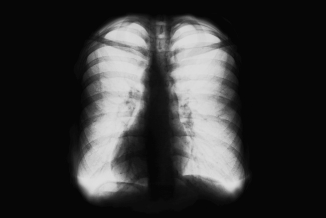 Infiltrat Paru, Kenali Penyebab dan Penanganannya - Alodokter