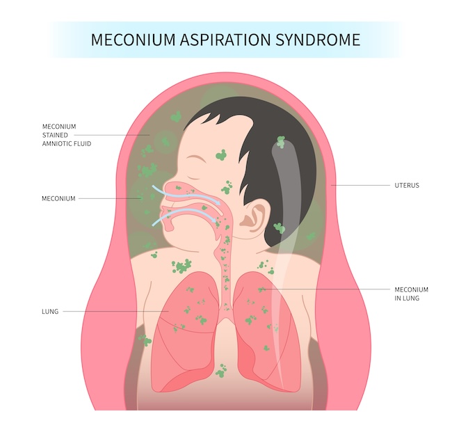 Diagnosis Meconium Aspiration Syndrome - Alomedika