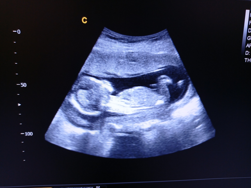 Hasil USG Janin 18 Minggu, Apa Saja yang Terlihat? - Alodokter