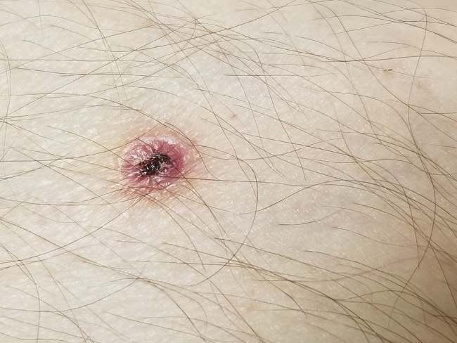 Pyoderma, Kenali Ciri-Ciri dan Cara Mengatasinya - Alodokter