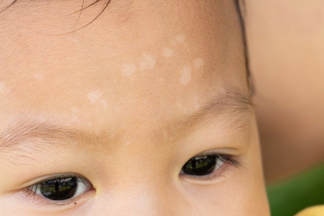 Bercak Putih pada Kulit Bayi, Inilah Berbagai Penyebab dan Cara ...