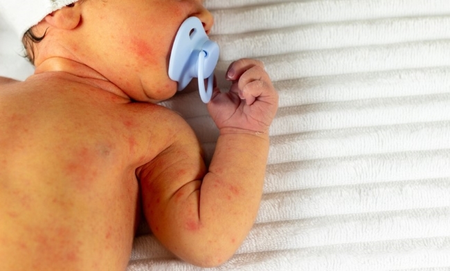 7 Ciri-Ciri Bayi Kuning yang Berbahaya yang Perlu Orang Tua Waspadai - Alodokter