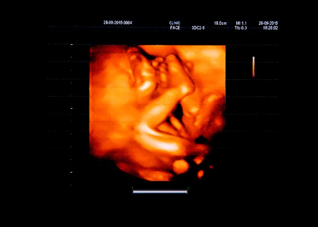 Ketahui Berat Janin Usia 5 Bulan dan Cara Menjaganya agar Tetap Normal ...