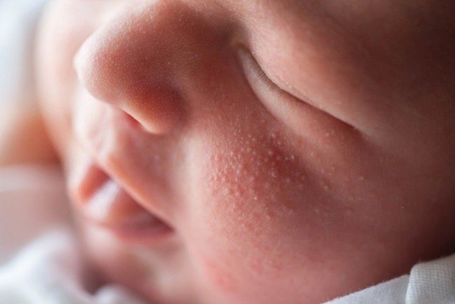 Bintik Putih pada Bayi seperti Nanah, Ketahui Penyebab dan ...
