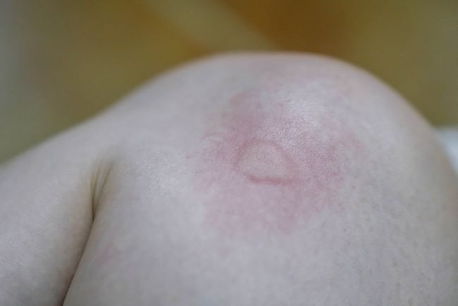 Gatal di Paha dan Bentol Merah, Ini Penyebab dan Tips Mengatasinya ...