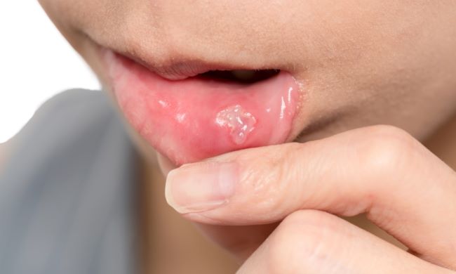 Berapa Hari Sariawan Sembuh? Ini Jawaban dan Cara Mempercepat ...