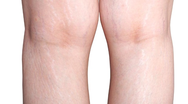 Stretch Mark di Betis, Ketahui Penyebab dan Cara Memudarkannya - Alodokter