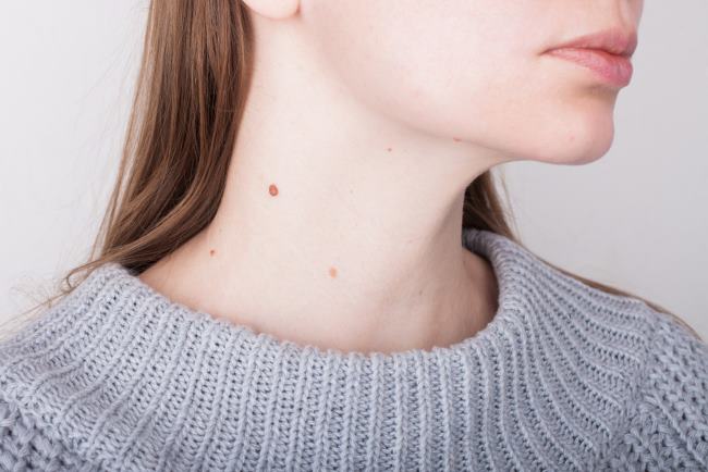 7 Cara Menghilangkan Kutil di Leher dengan Mudah - Alodokter