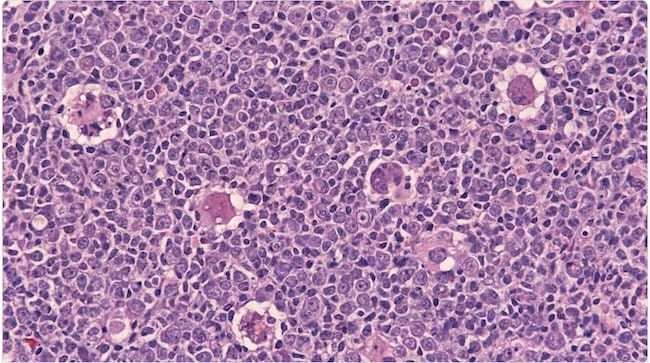Edukasi dan Promosi Kesehatan Burkitt Lymphoma - Alomedika