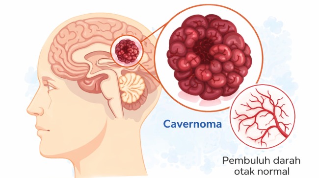 Cavernoma - Gejala, Penyebab, dan Pengobatan - Alodokter