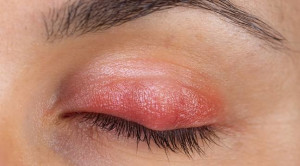 Penyebab Benjolan Di Kelopak Mata Bagian Bawah Yang Muncul Kembali ...