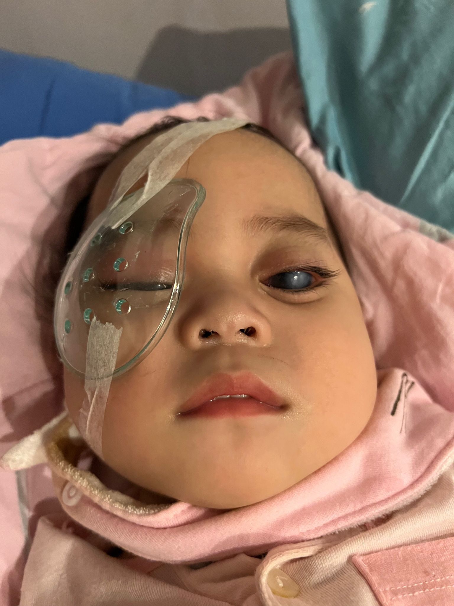 Please Help Baby Ngoc Chi To See The World [Gift Of Sight]
