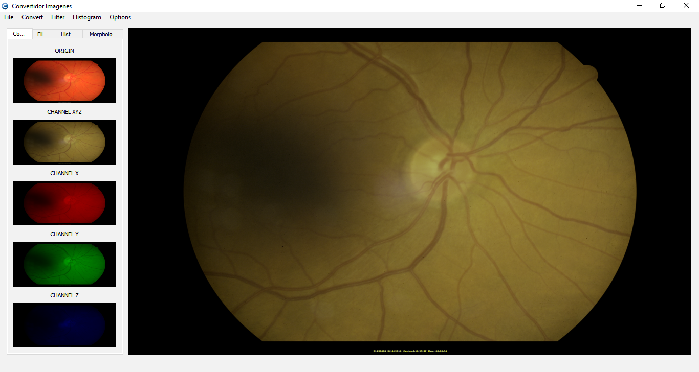 GitHub - dejuata/Retinal-image-processing: Software made in the course ...