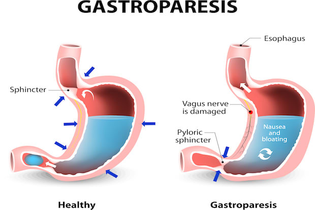 What are the Symptoms of Common Gastric Motility Disorders?