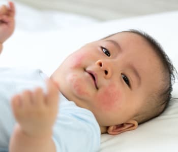 Urticaire bébé : reconnaître les symptômes et apprendre à la soigner