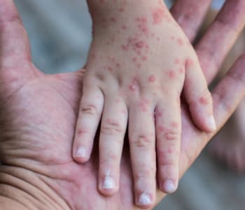 Wat is rodehond en hoe krijg je het? | De Roze Doos