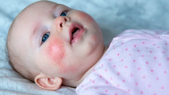 Tout savoir sur la roséole | La Boîte Rose