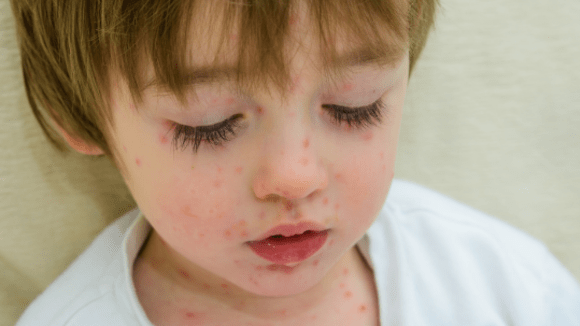 Help, mijn kind heeft windpokken! Wat nu? | De Roze Doos