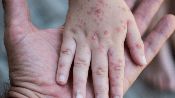 Wat is rodehond en hoe krijg je het? | De Roze Doos