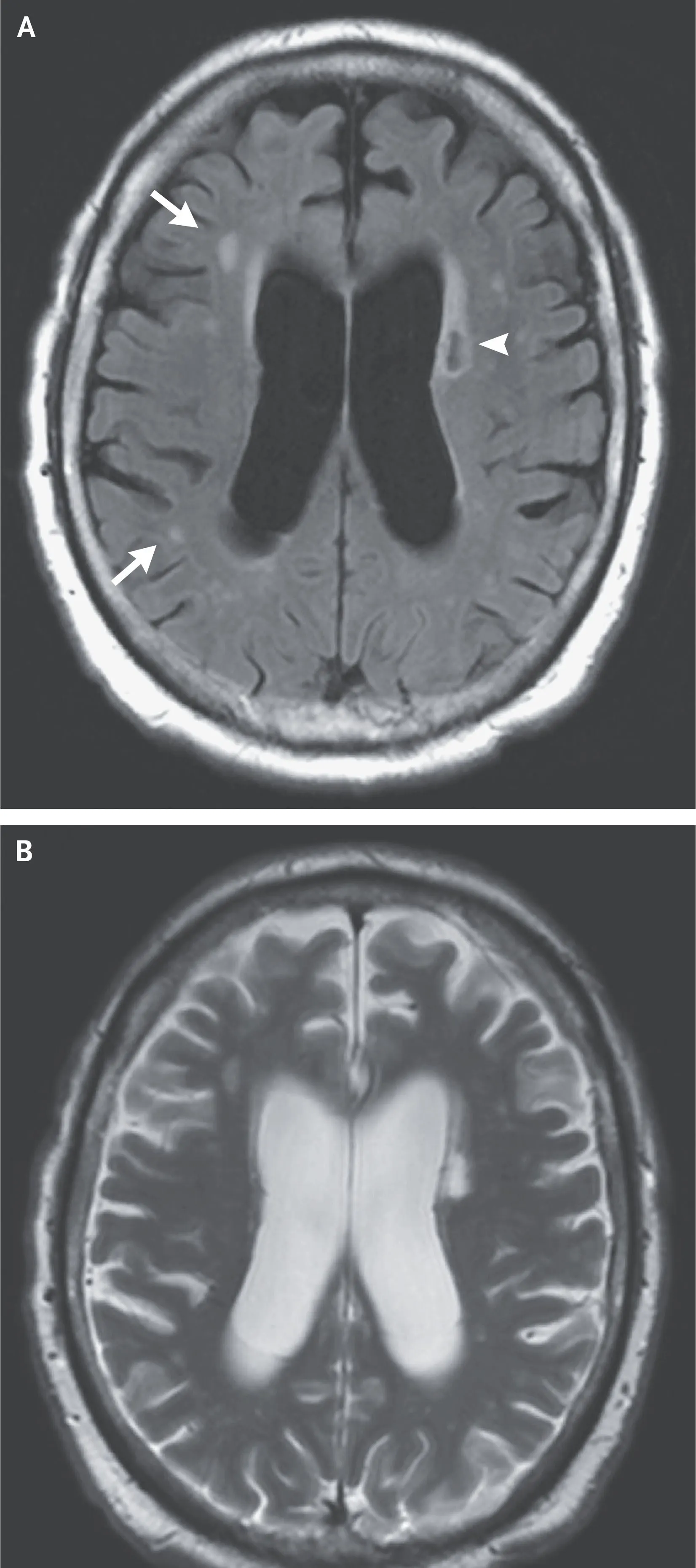 Hidrocefalia Antes Y Después De La Resonancia Magnética