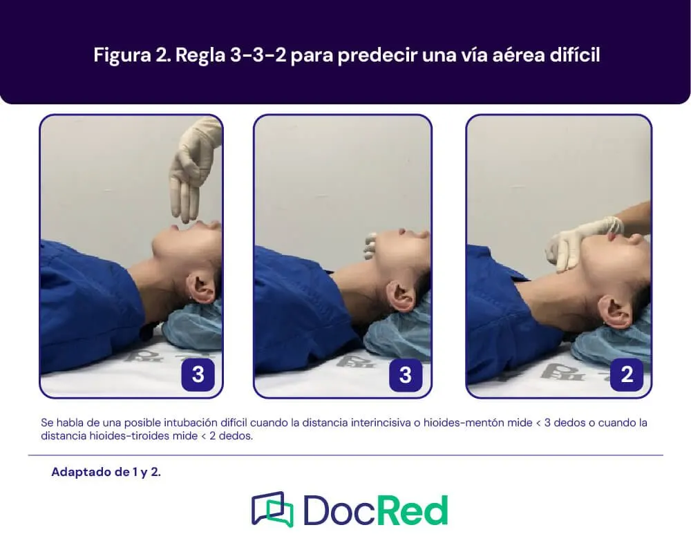 Regla 3-3-2 para predecir vía aérea difícil