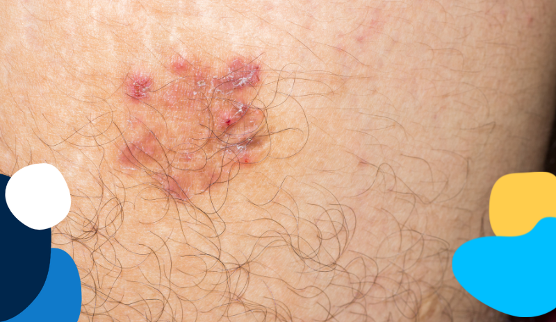 Pemfigo: classificazione, sintomi, cause | Doctolib