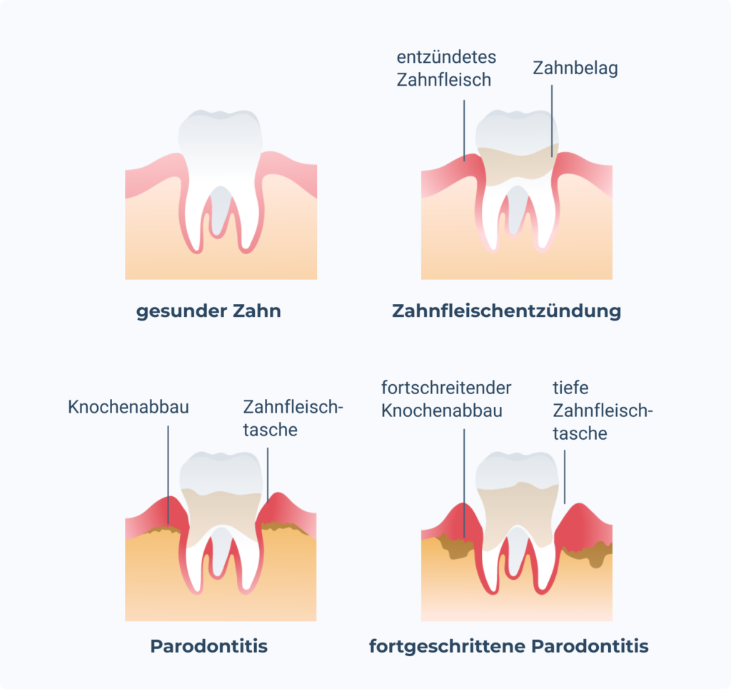Parodontitis: Ursachen, Symptome & Behandlung
