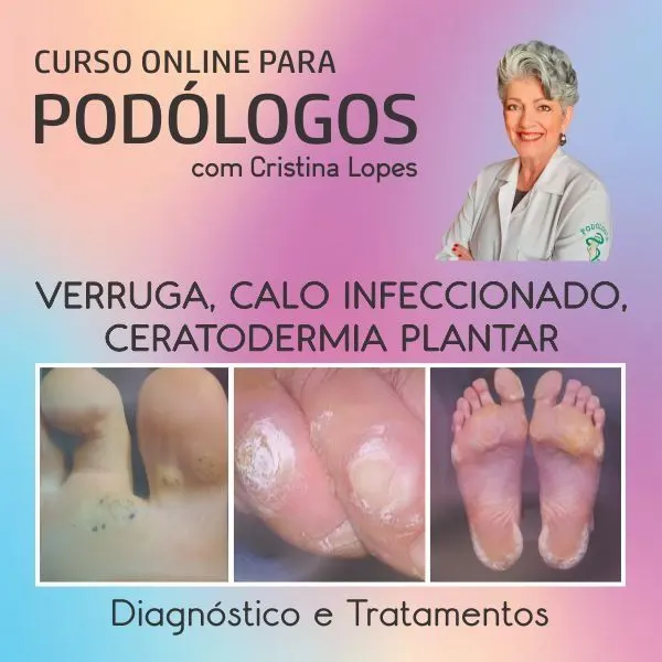 Verruga Plantar, Calo Infeccionado E Certodermia Plantar - Diagnóstico ...
