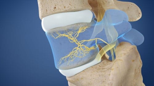 Intracept Procedure for Low Back Pain | Cantor Spine Institute