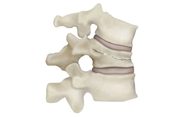 Spinal Fracture Treatment - Ballon Kyphoplasty | Cantor Spine Center