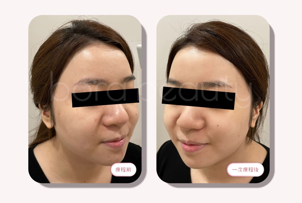 Einxel Plus 膠原修復槍 | Bora Beauty