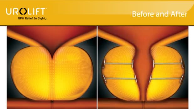 New Procedure Provides Patients with Life-Changing Results | Iredell ...