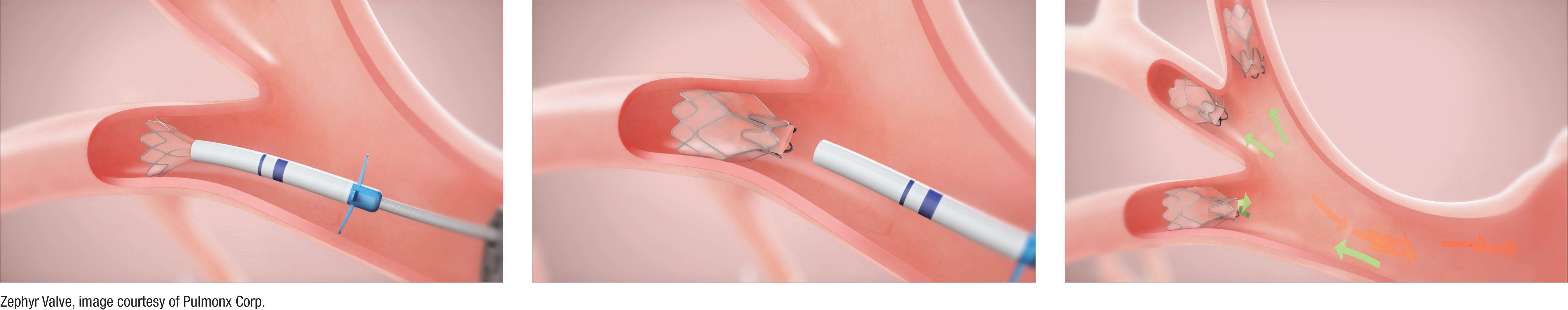 Pulmonology | Lake Regional Health System