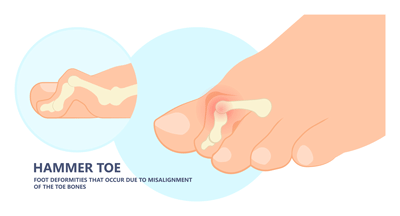 Hammertoe | Pella Regional Health Center