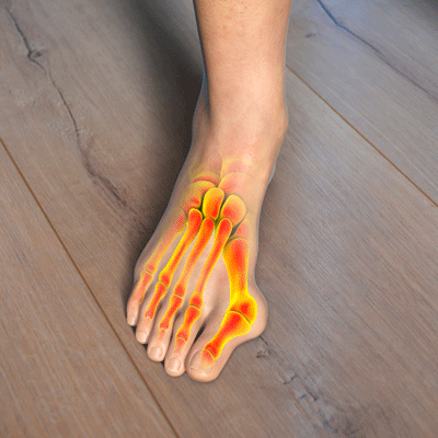 Bunions | Pella Regional Health Center